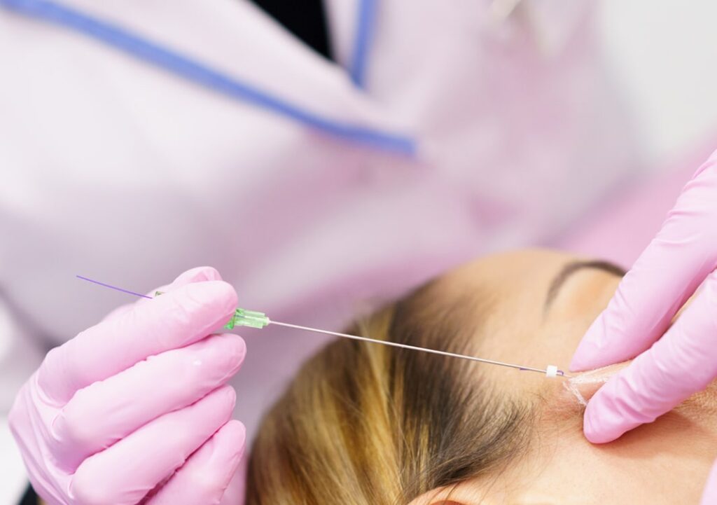 Nova PDO Threads - DermaVogue